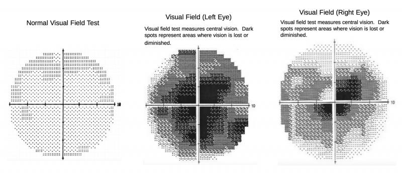 Heather Napolitano sheds light on losing eyesight | Cape Gazette